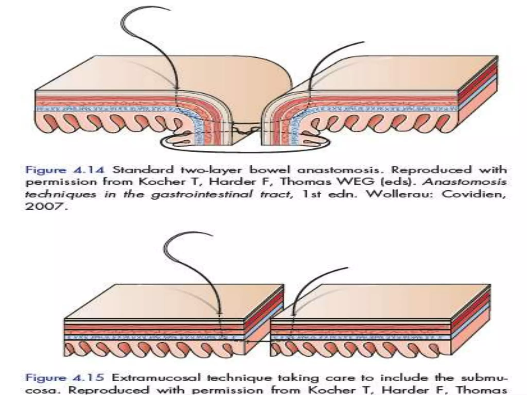 Basic surgical skill and anastomoses | PPTX