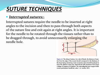 Basic surgical skill and anastomoses | PPTX