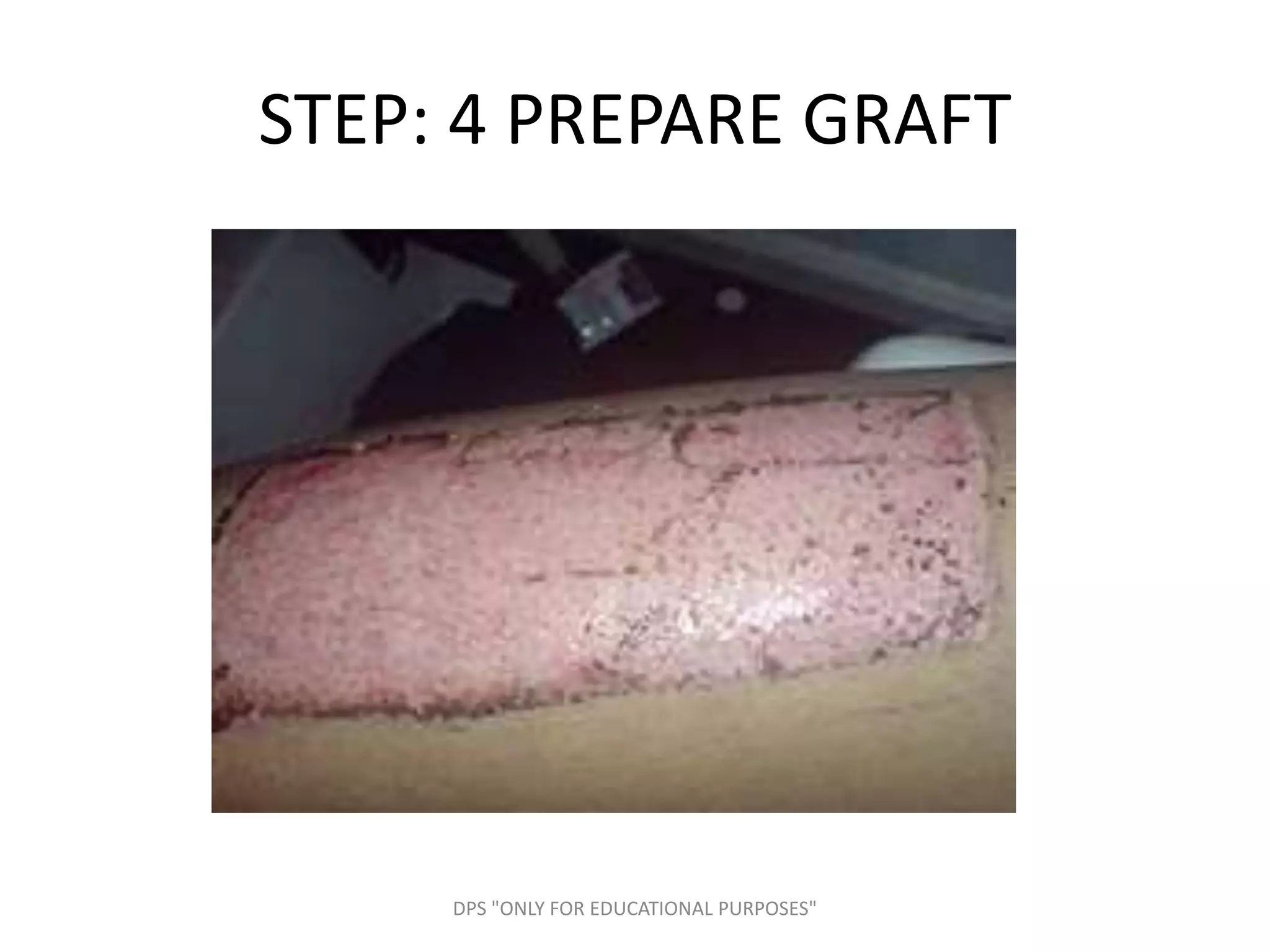 Basic surgical steps for split thickness skin grafting. dr. d.p. swami ...