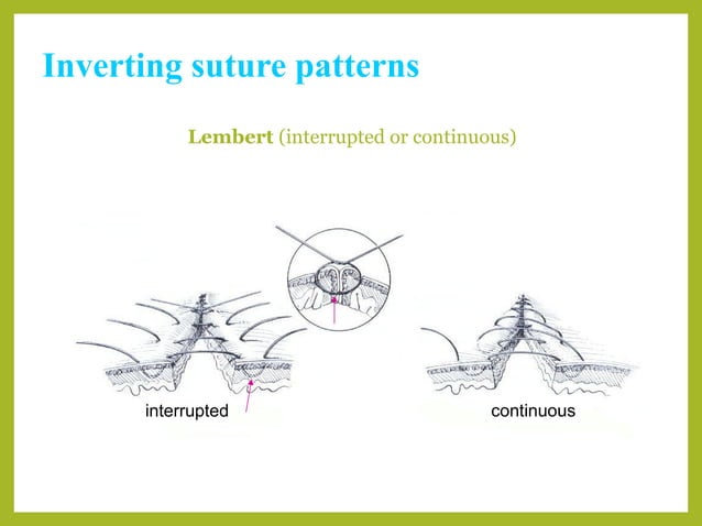 Basic suture patterns | PPT