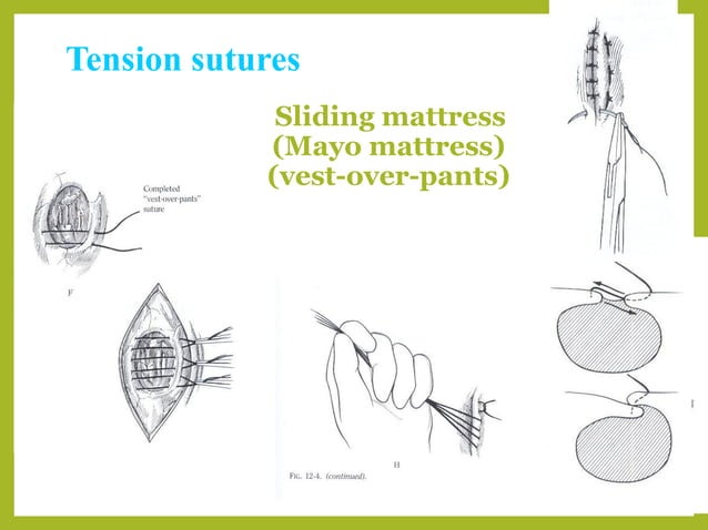 Basic suture patterns | PPT