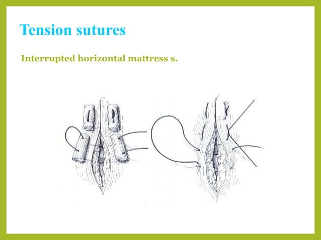 Basic suture patterns | PPT