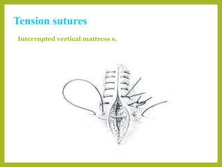 Basic suture patterns | PPT