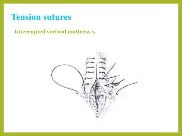 Basic suture patterns | PPT