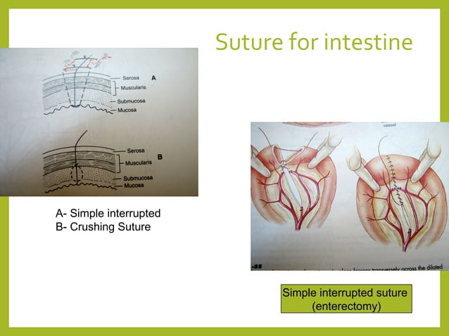 Basic suture patterns