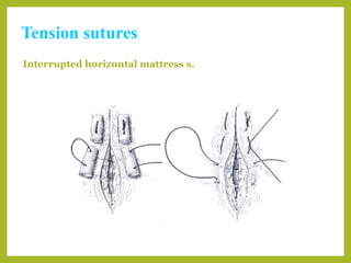 Basic suture patterns | PPT
