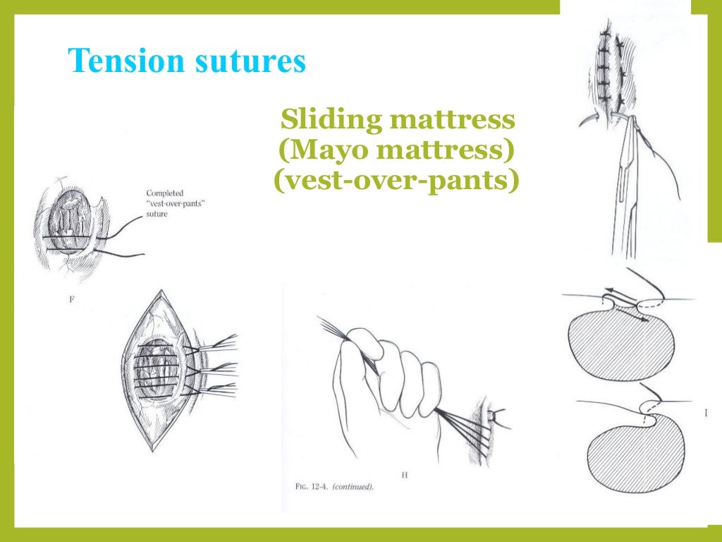 Basic suture patterns
