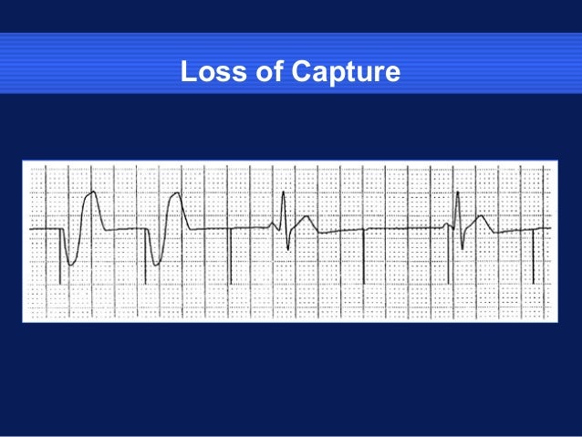 Basic technical concepts in cardiac pacing
