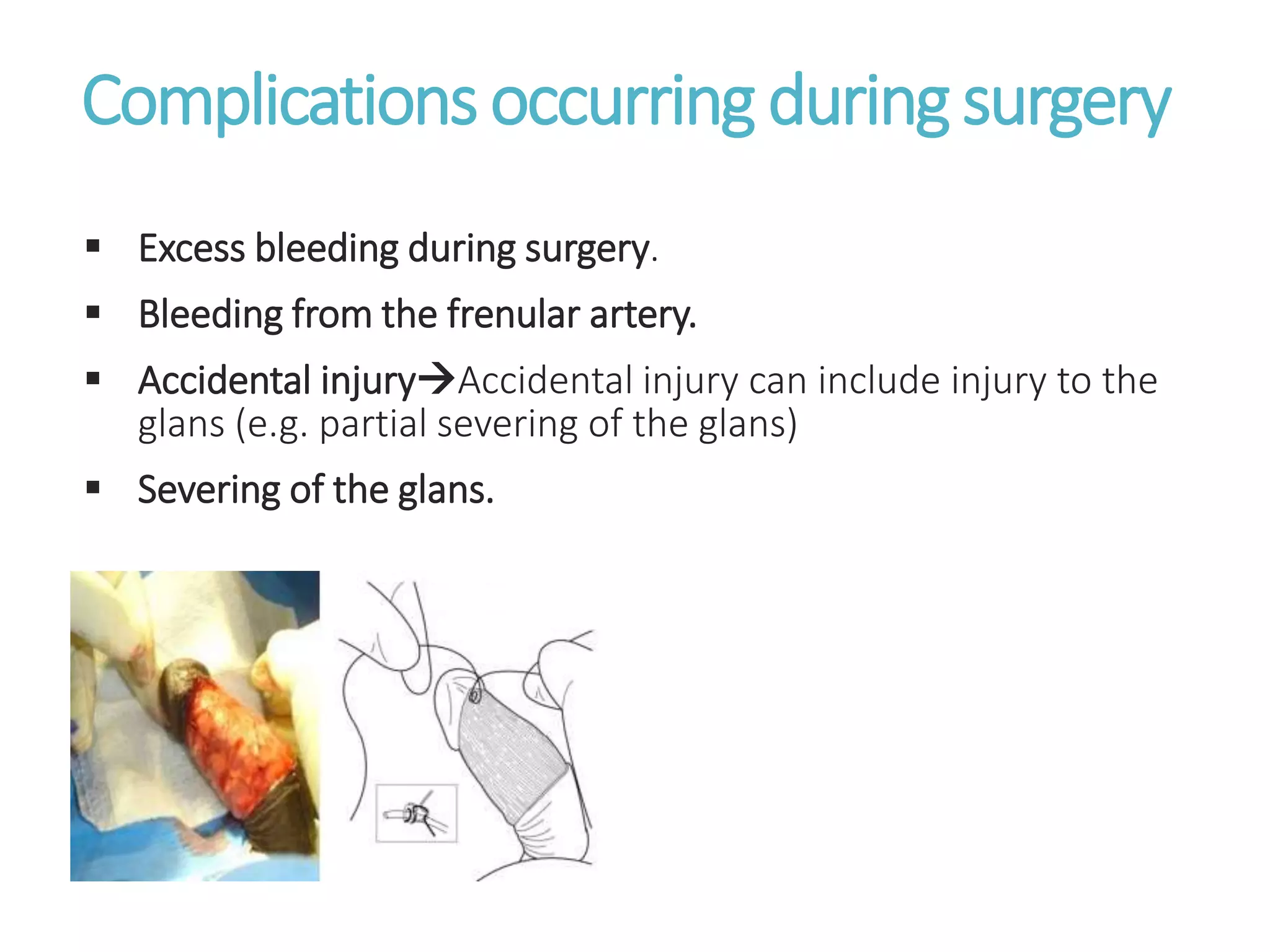 Basic technique of circumcision by regi septian | PPSX