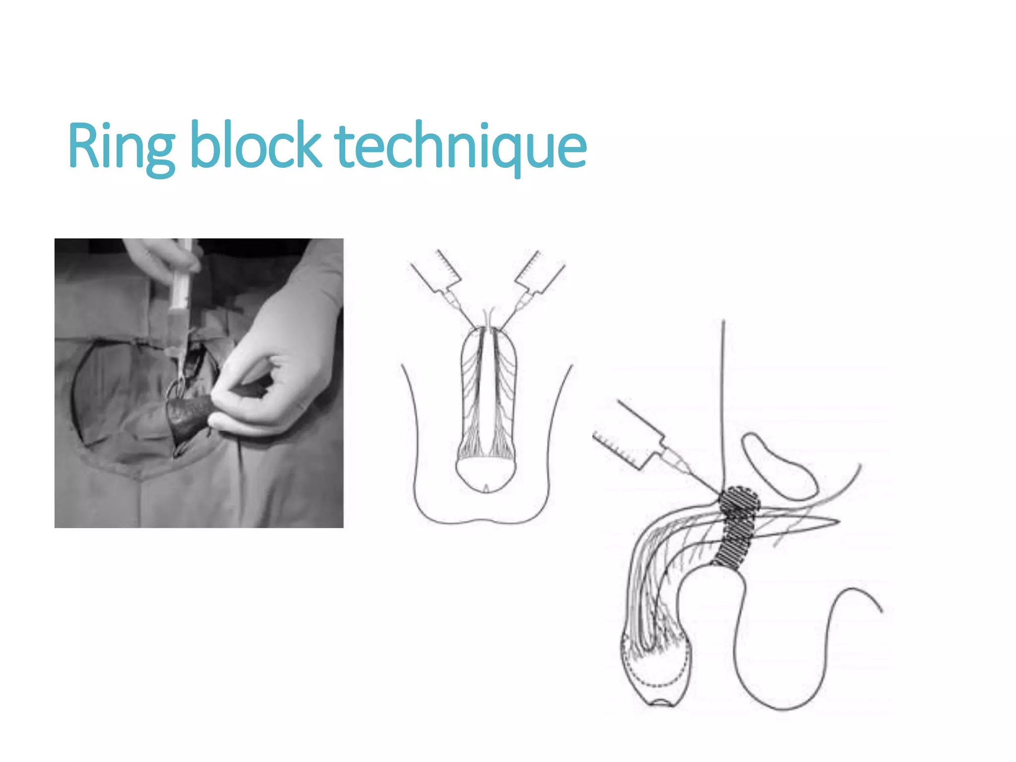 Basic technique of circumcision by regi septian | PPSX