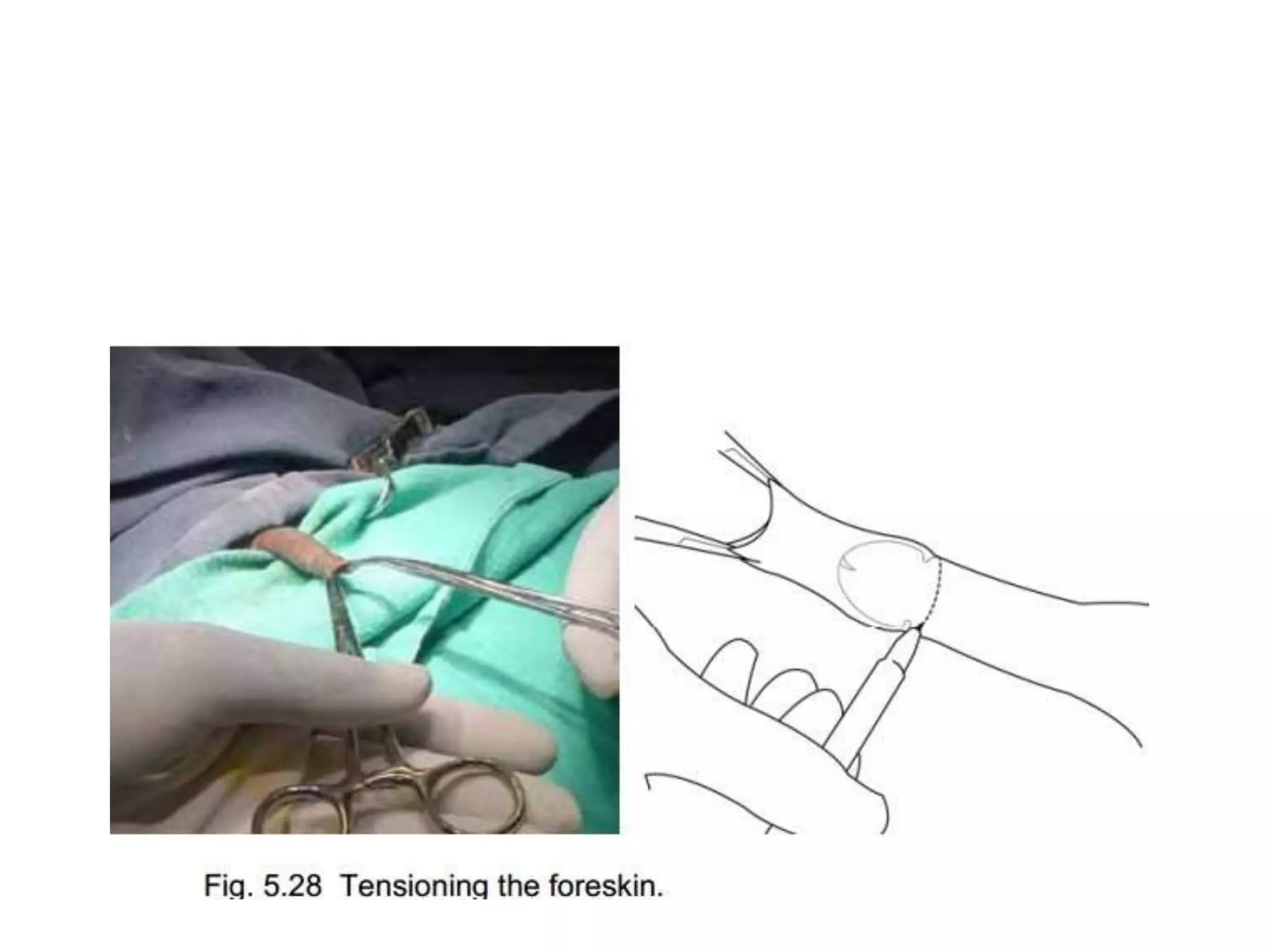 Basic technique of circumcision by regi septian | PPSX