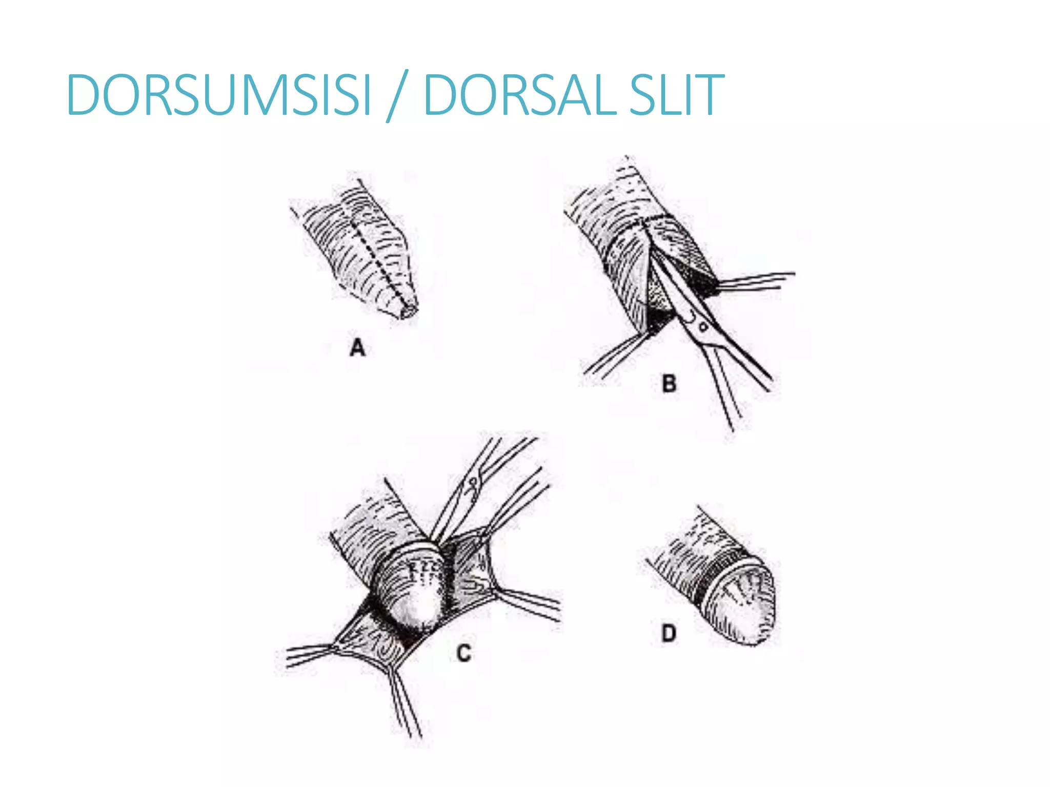 Basic technique of circumcision by regi septian | PPSX