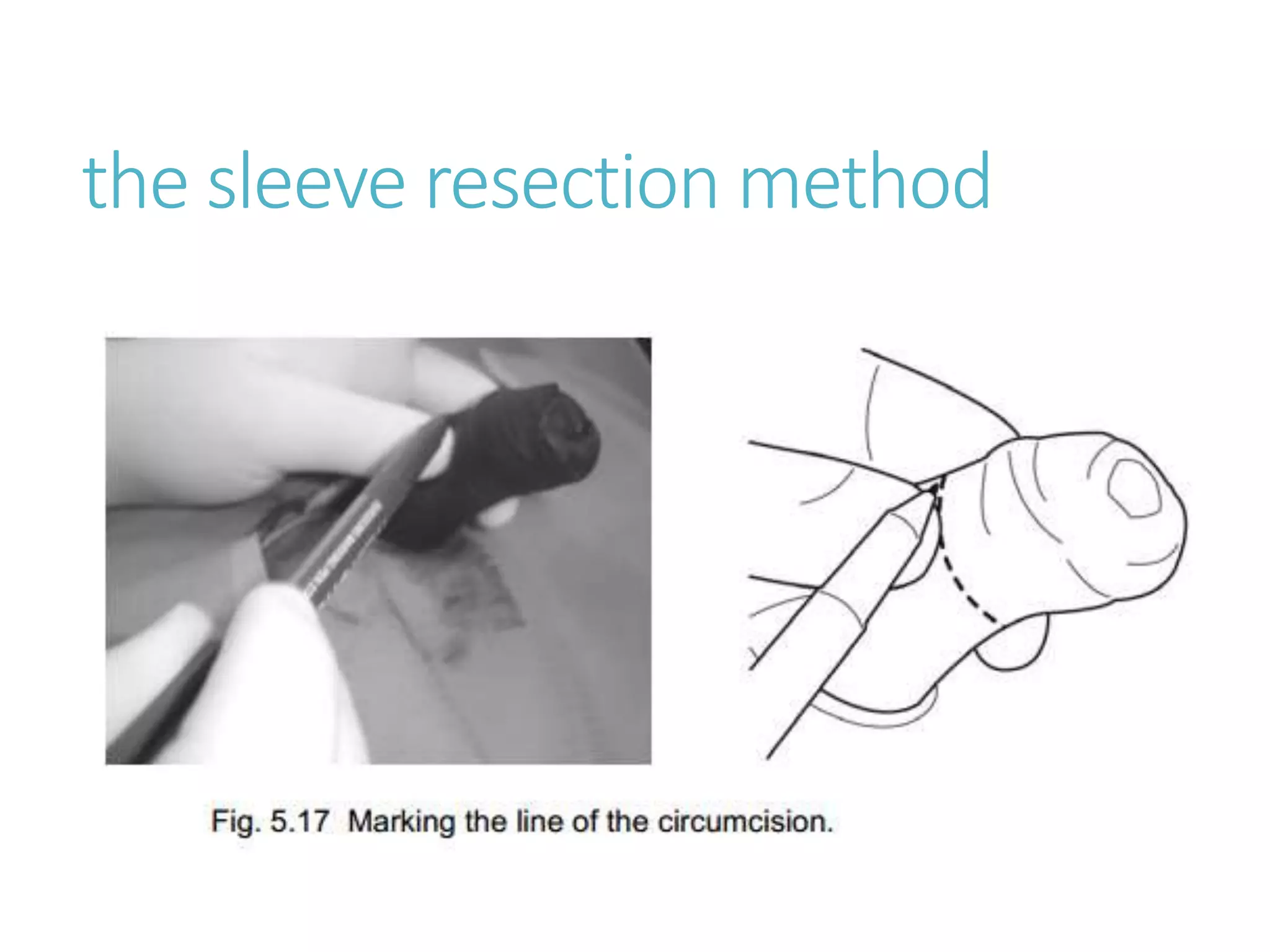 Basic technique of circumcision by regi septian | PPSX