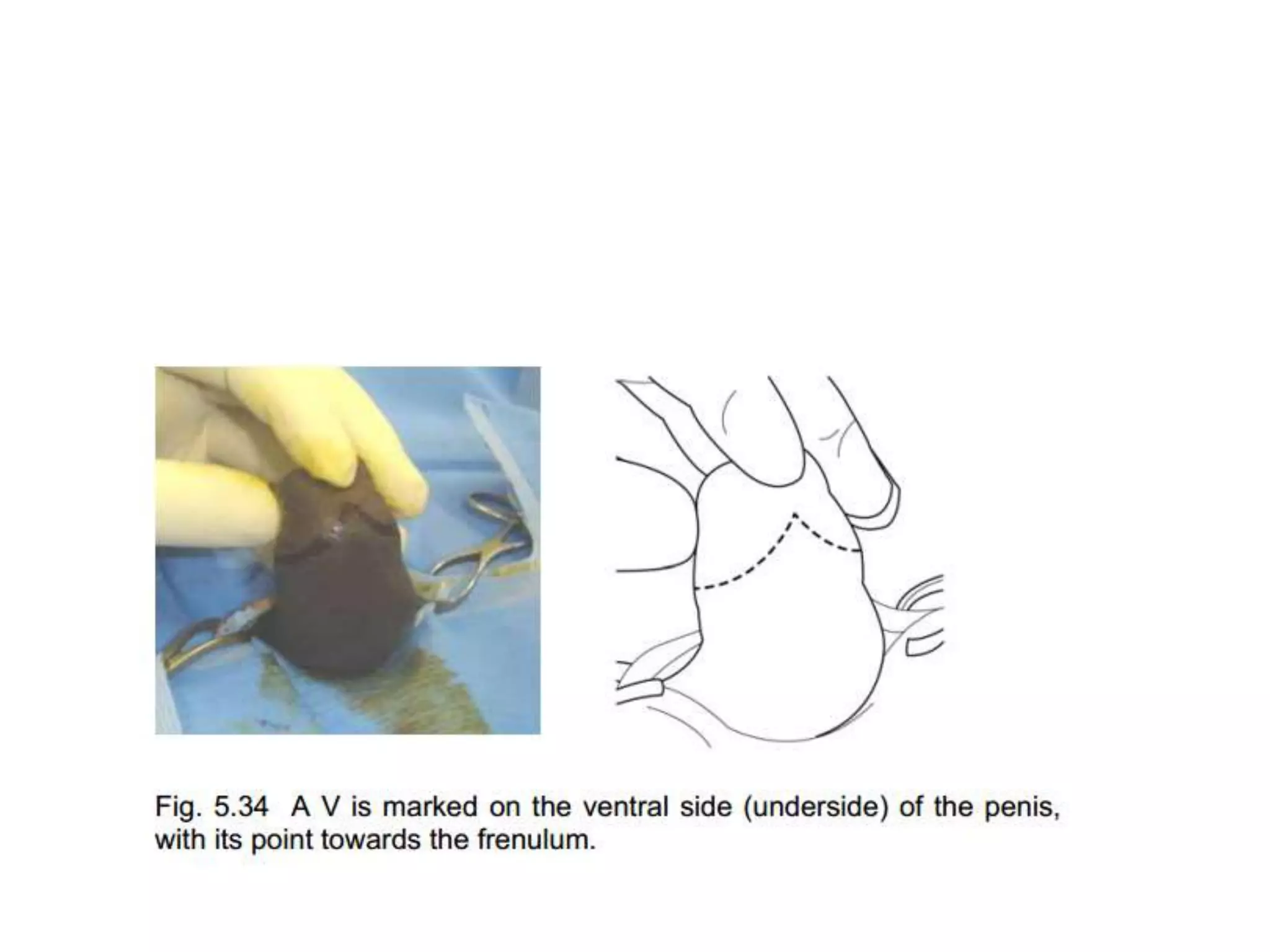 Basic technique of circumcision by regi septian | PPSX