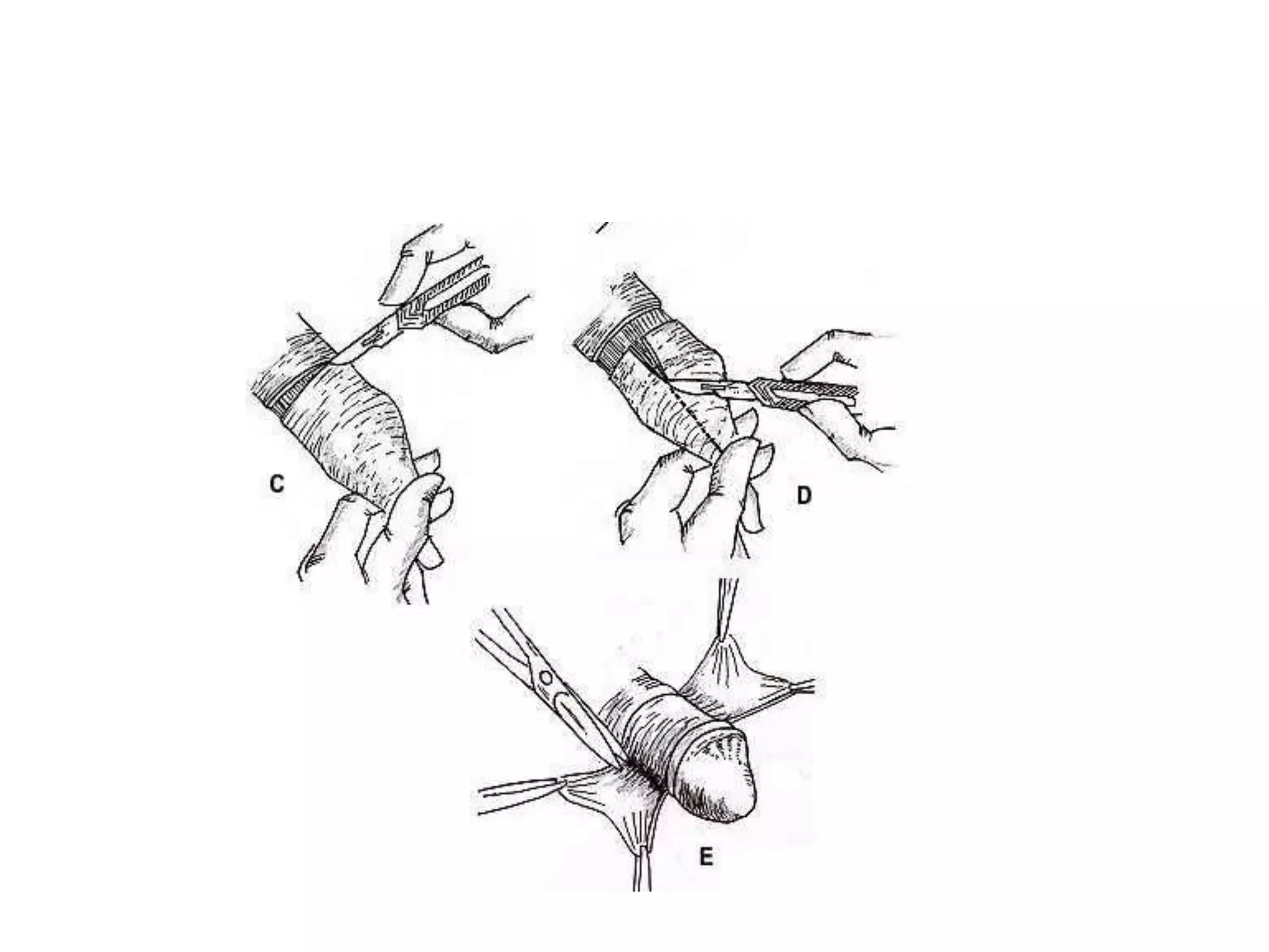 Basic technique of circumcision by regi septian | PPSX