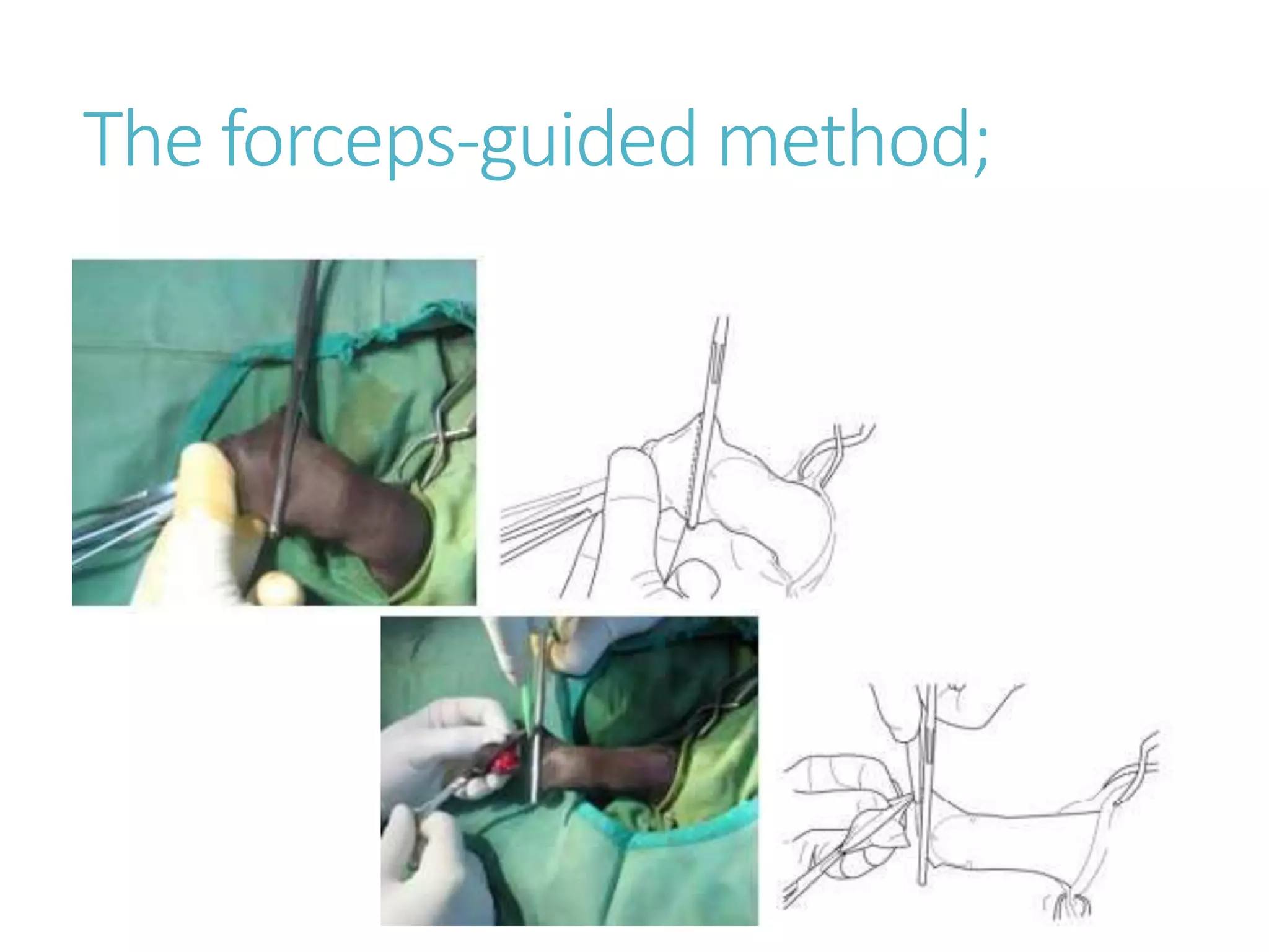 Basic technique of circumcision by regi septian | PPSX