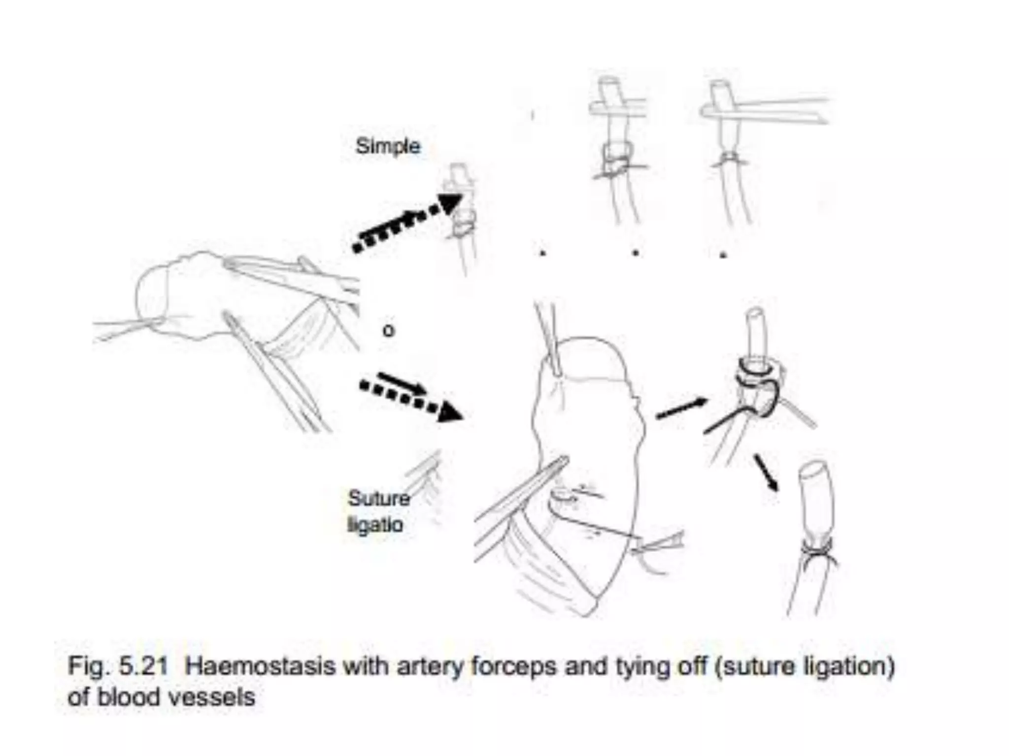 Basic technique of circumcision by regi septian | PPSX