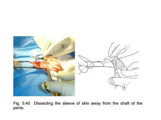 Basic technique of circumcision by regi septian | PPSX