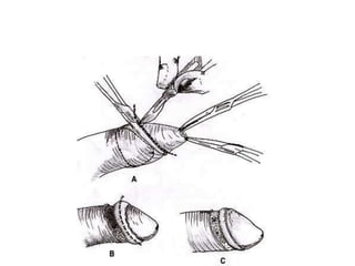 Basic technique of circumcision by regi septian | PPSX