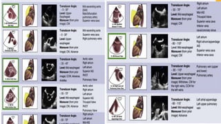 Basic transesophageal echo TEE anaesthesia | PPTX