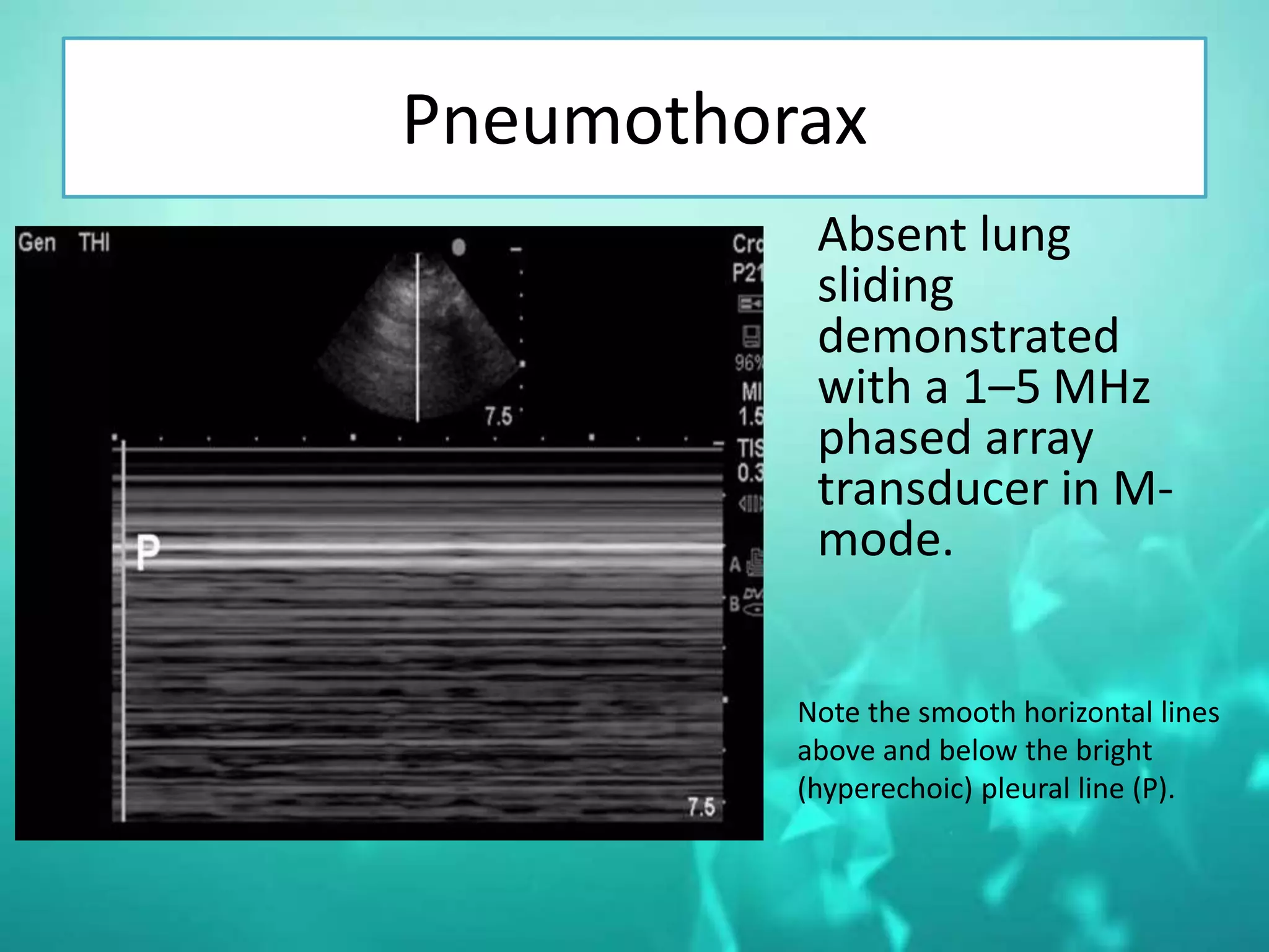 Basic ultrasound in icu | PPTX