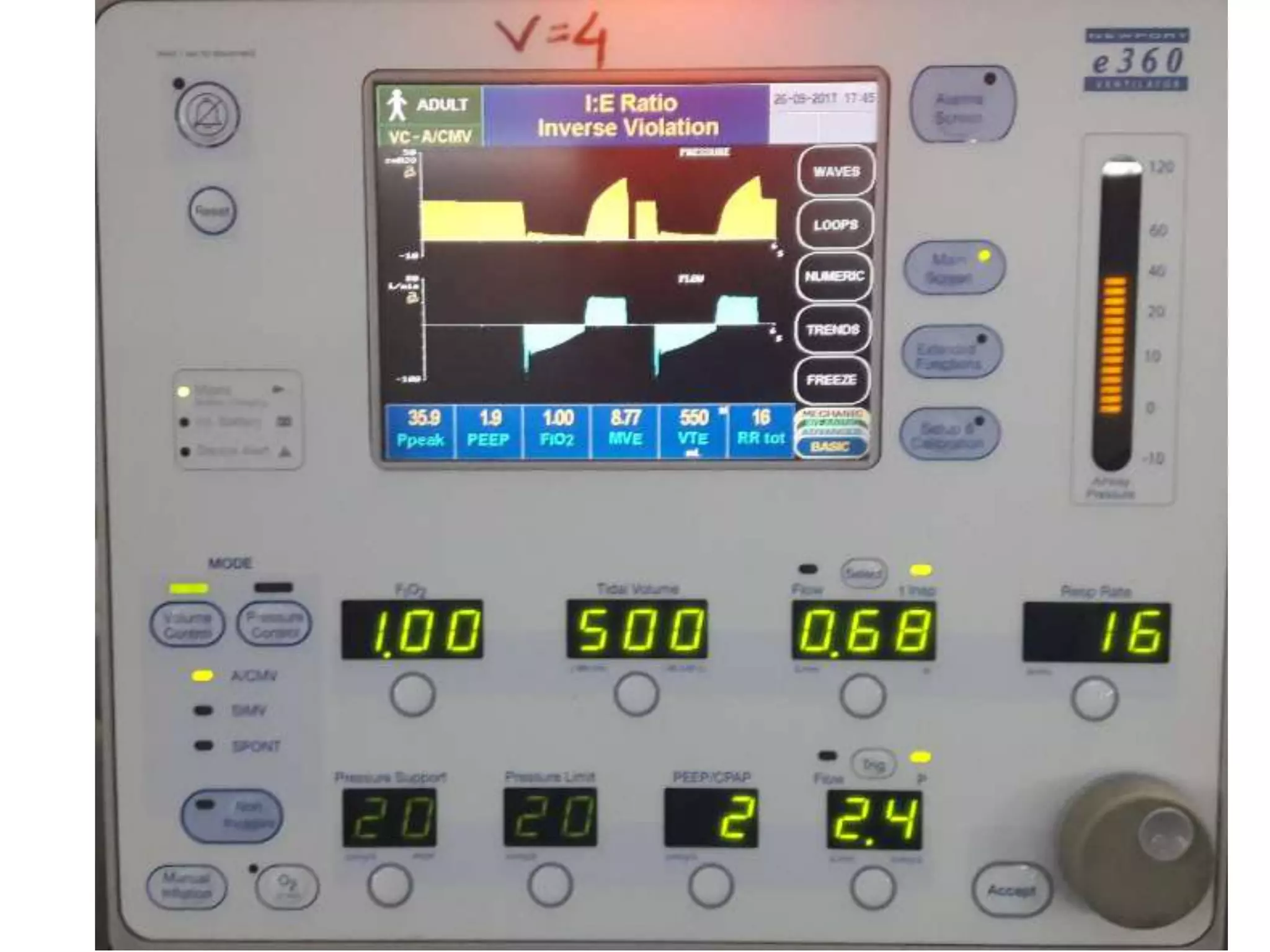 Basic ventilator management | PPTX