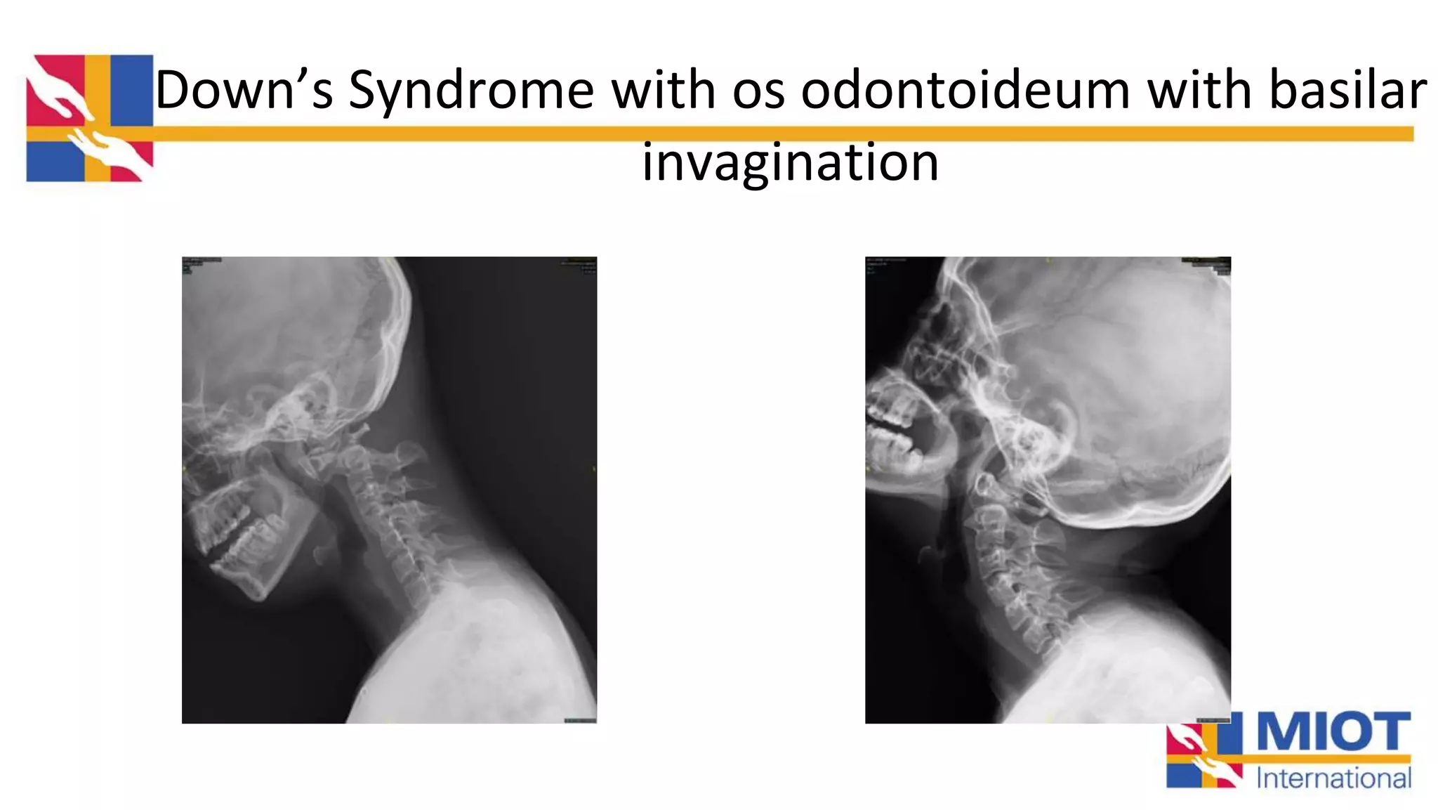 Basilar invagination | PPTX
