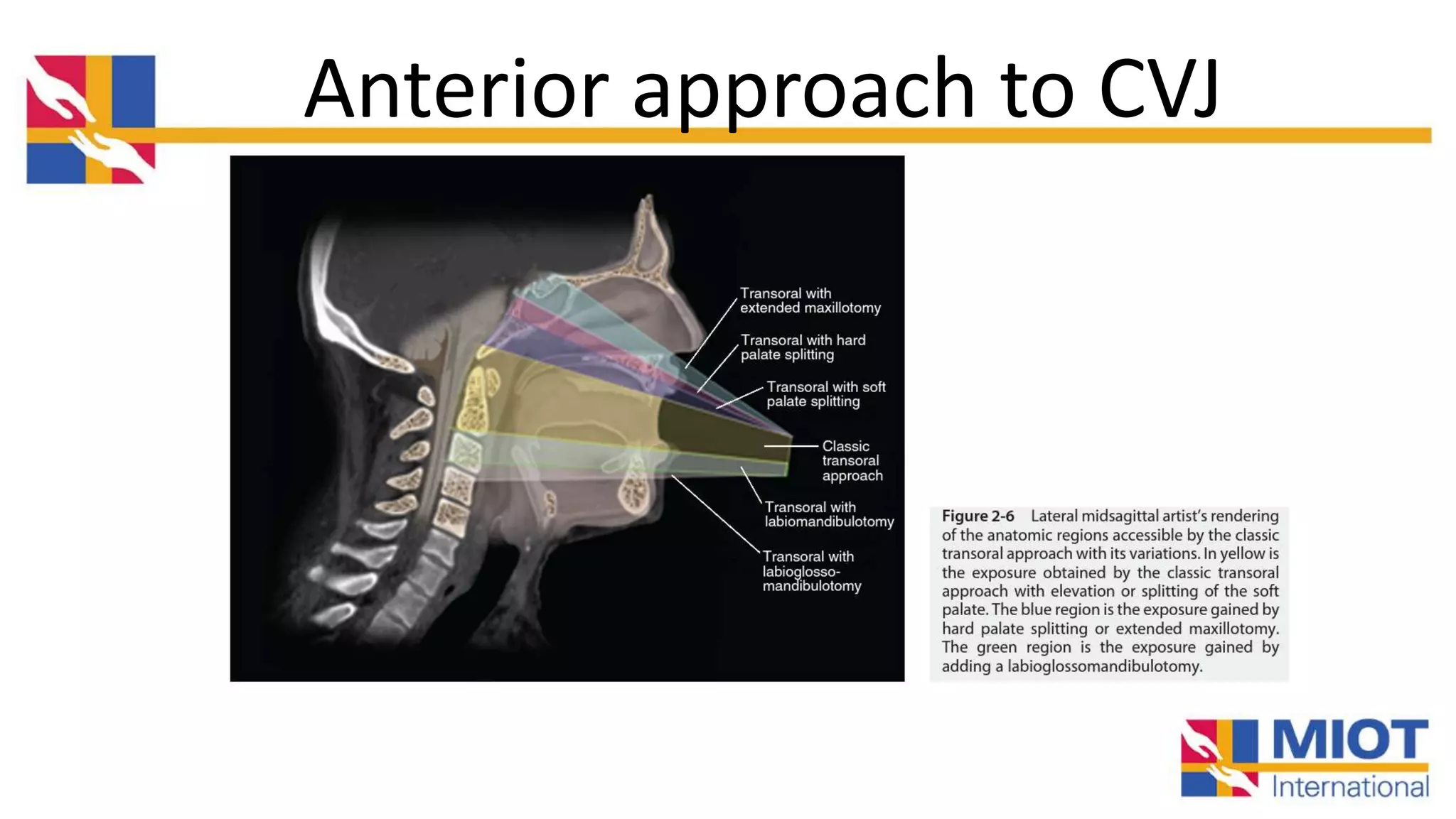 Basilar invagination | PPTX