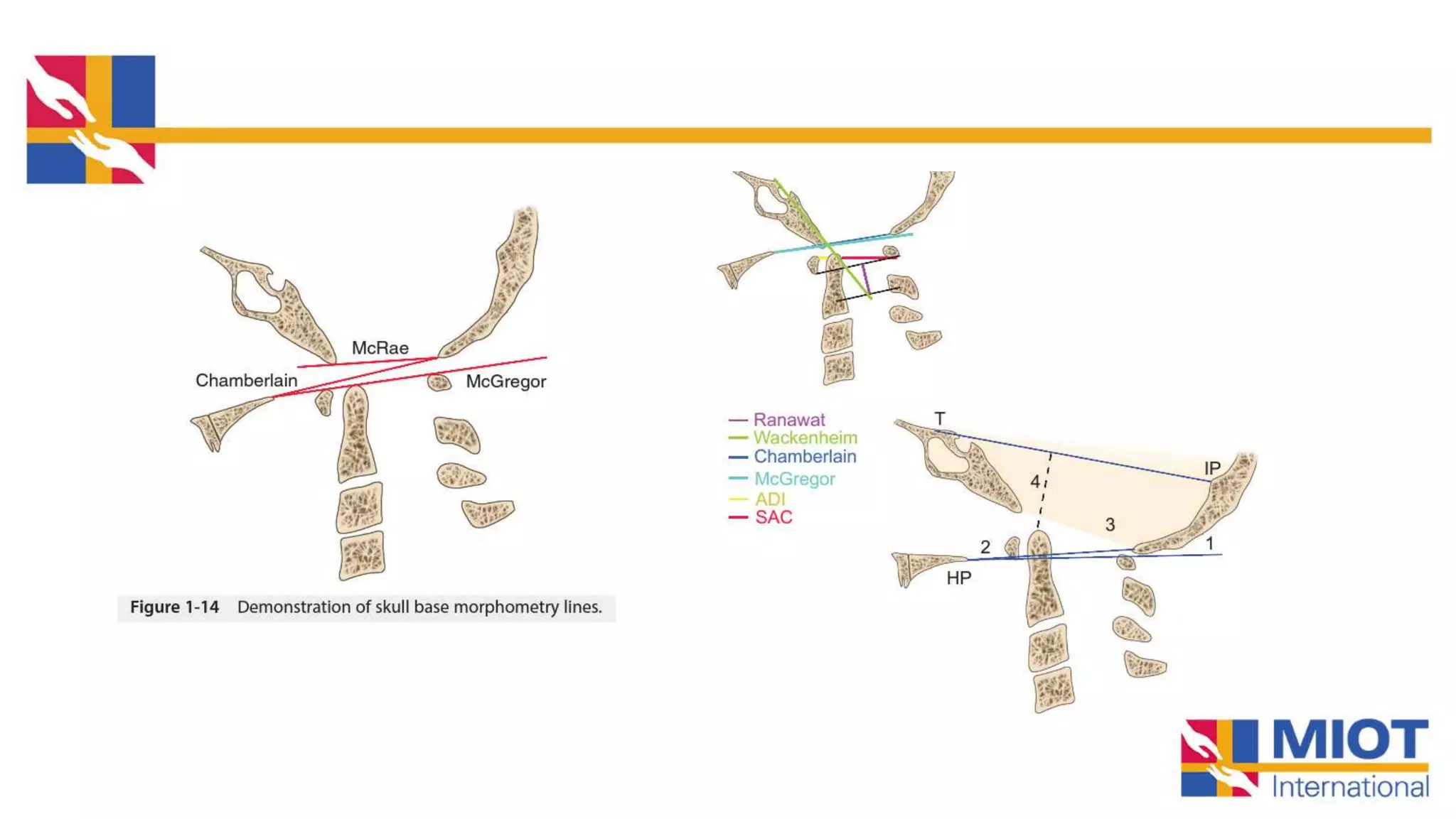 Basilar invagination | PPTX