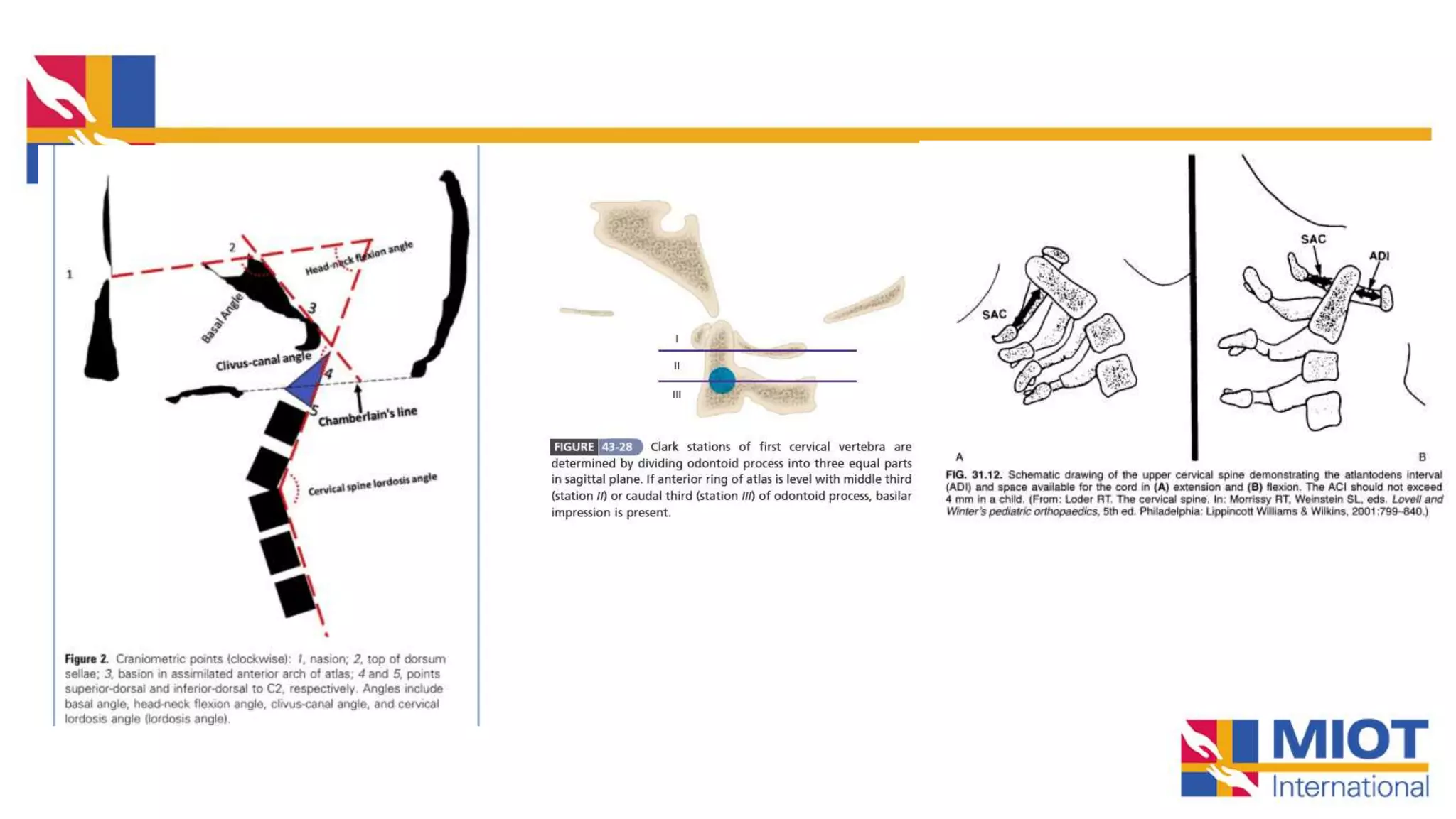 Basilar invagination | PPTX