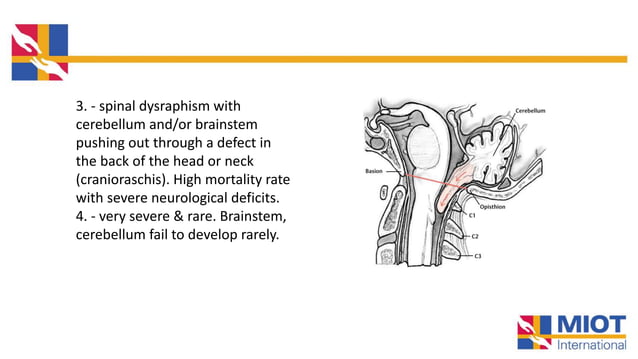Basilar invagination | PPTX