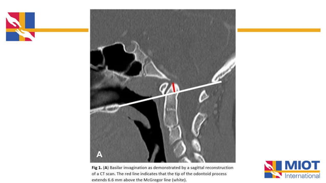 Basilar invagination | PPTX