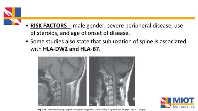 Basilar invagination | PPTX