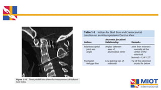 Basilar invagination | PPTX