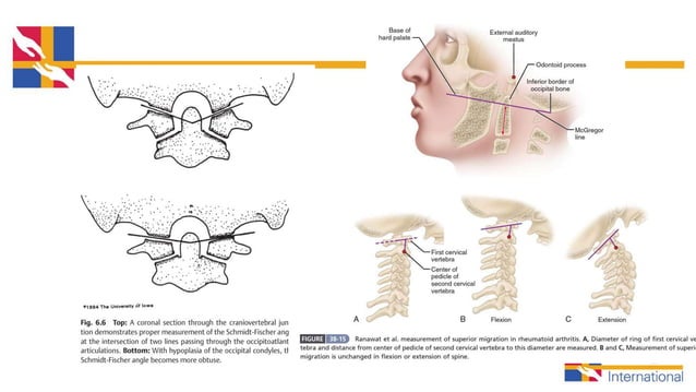 Basilar invagination | PPTX