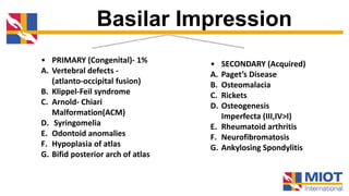 Basilar Impression