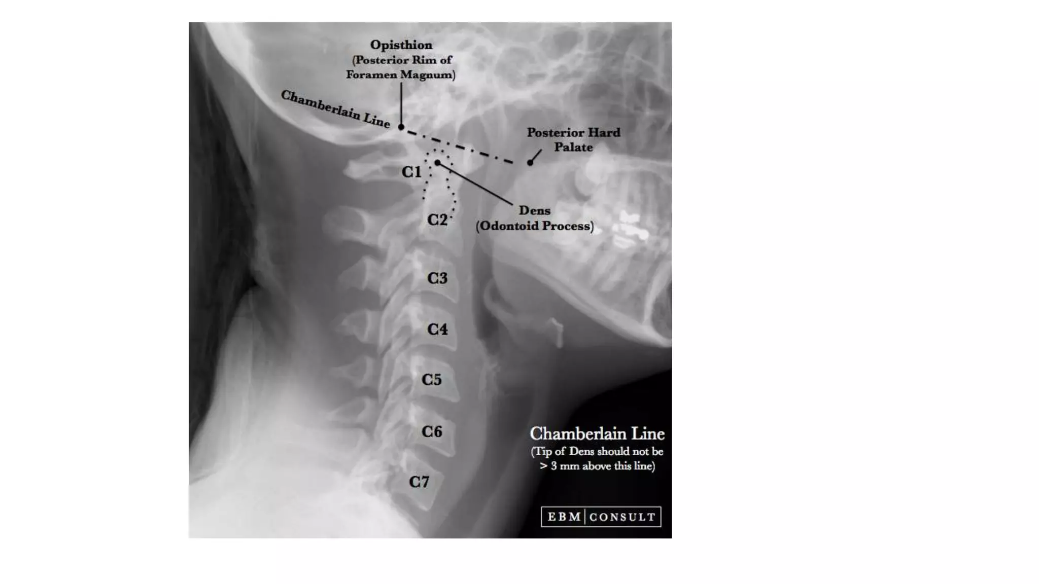Basilar invagination | PPTX