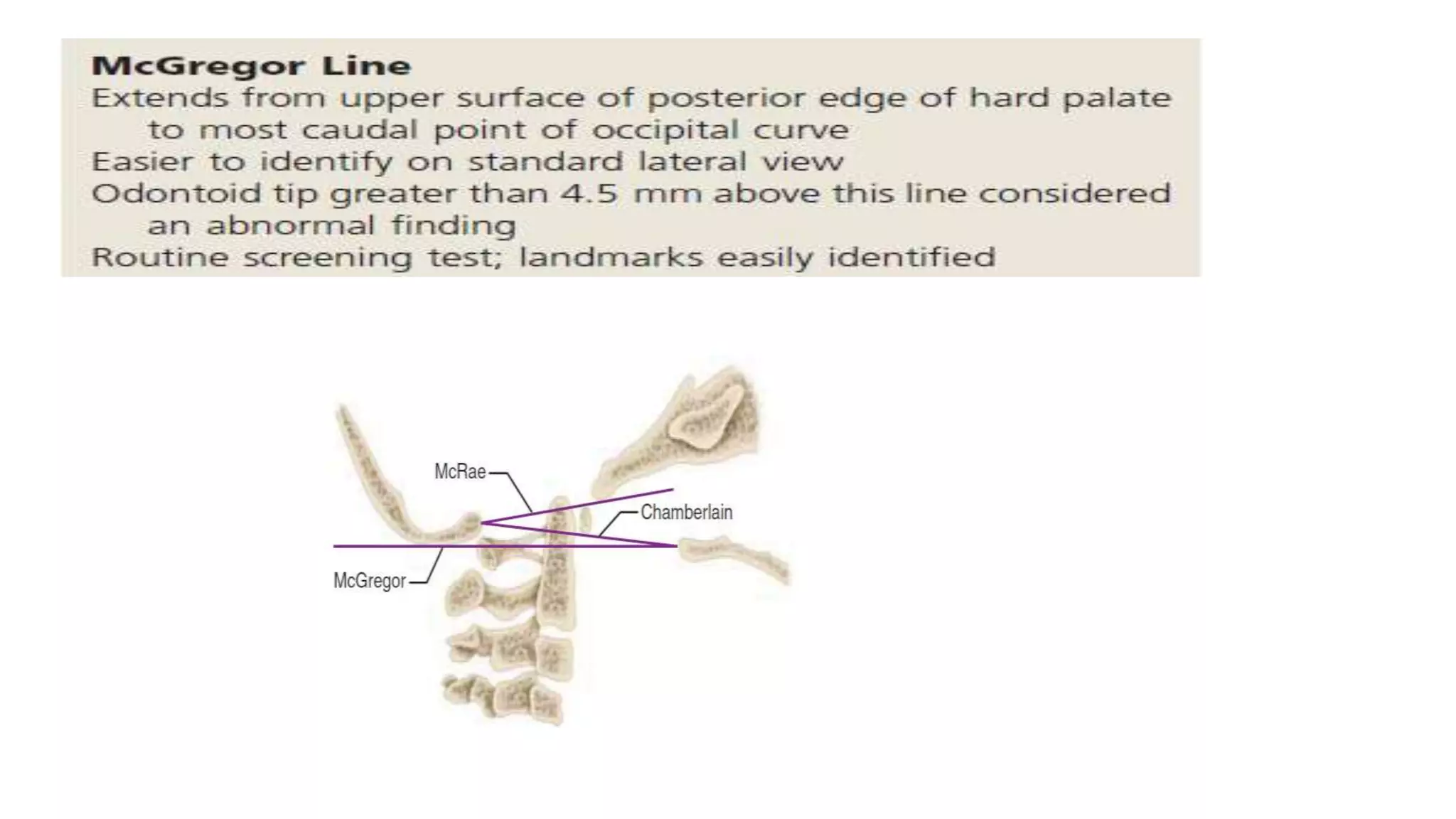 Basilar invagination | PPTX