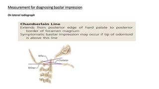 Basilar invagination | PPTX