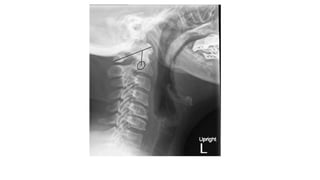 Basilar invagination | PPTX