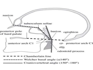 BASILAR INVAGINATION.pptx................ | PPTX