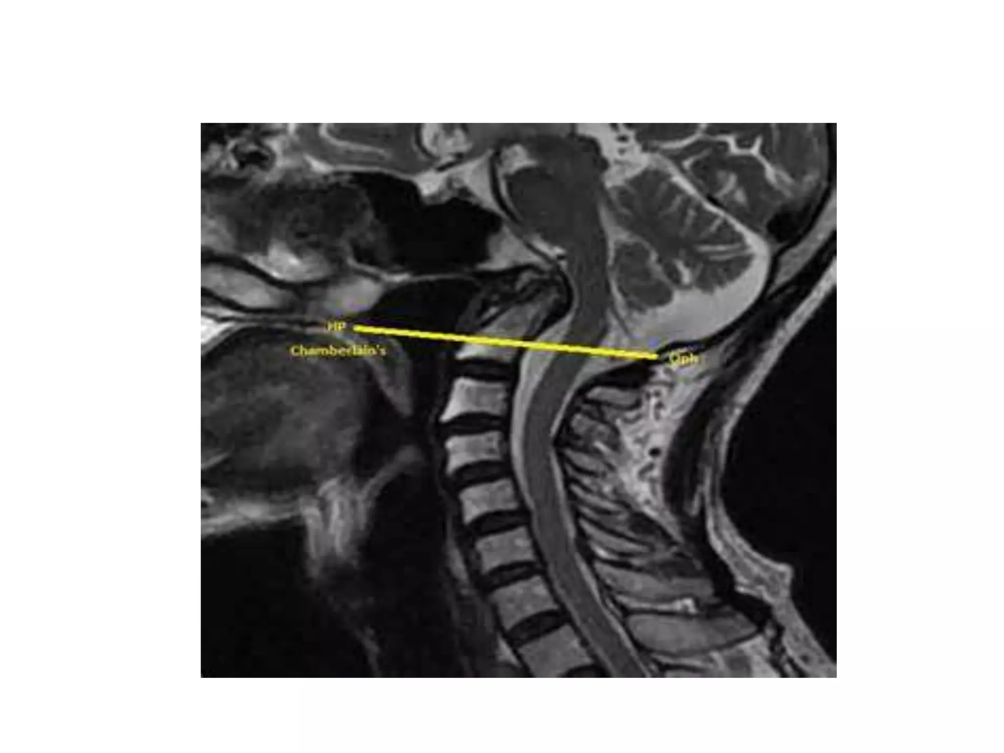 Basilar invagination lines | PPTX