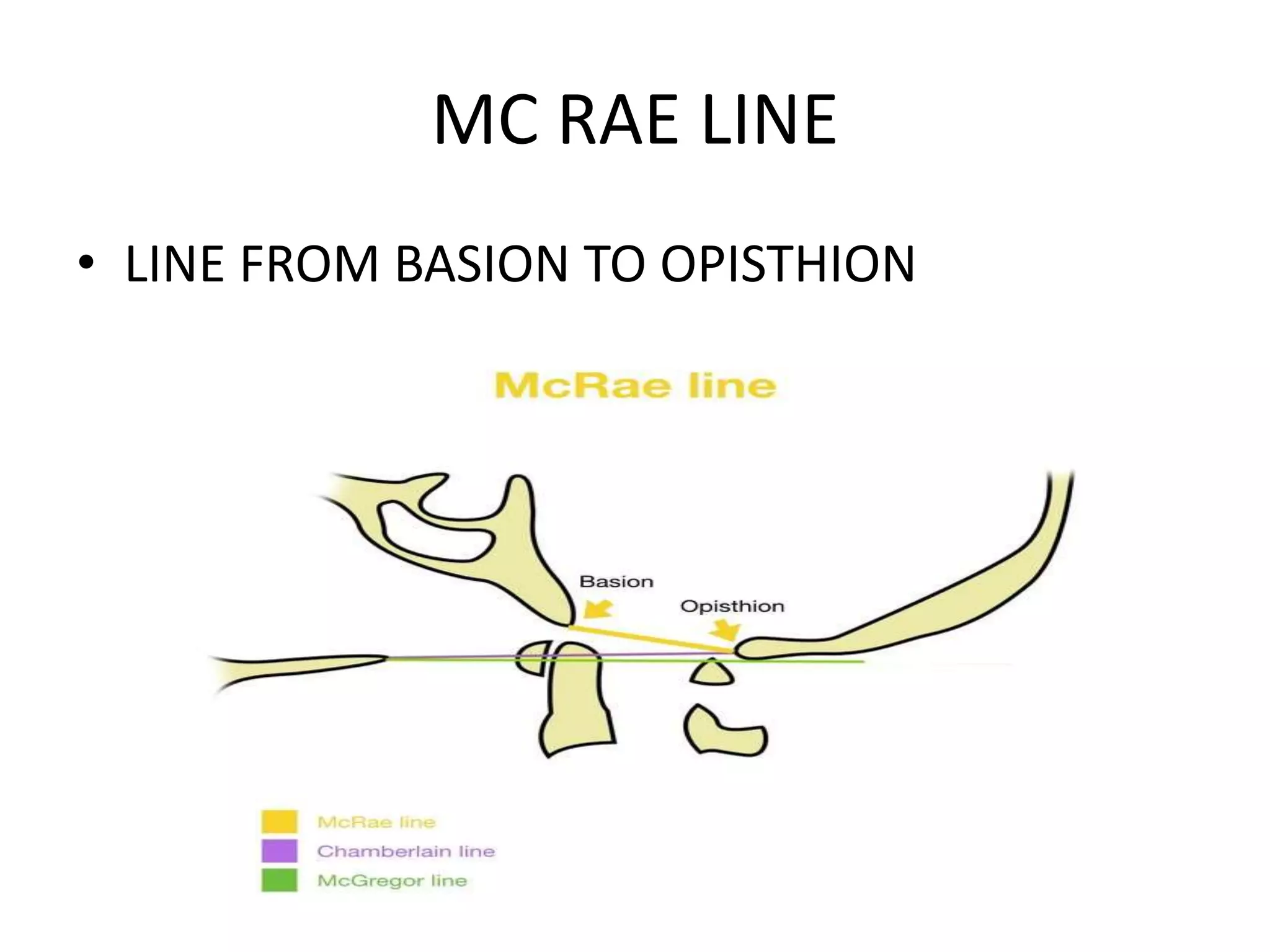 Basilar invagination lines | PPTX