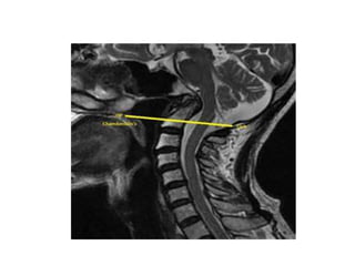 Basilar invagination lines | PPTX