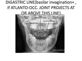 Basilar invagination lines | PPTX