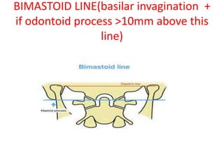 Cranial Settling Vs Basilar Invagination – UKZFM