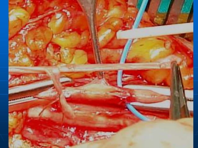 Basilic vein transposition | PPT