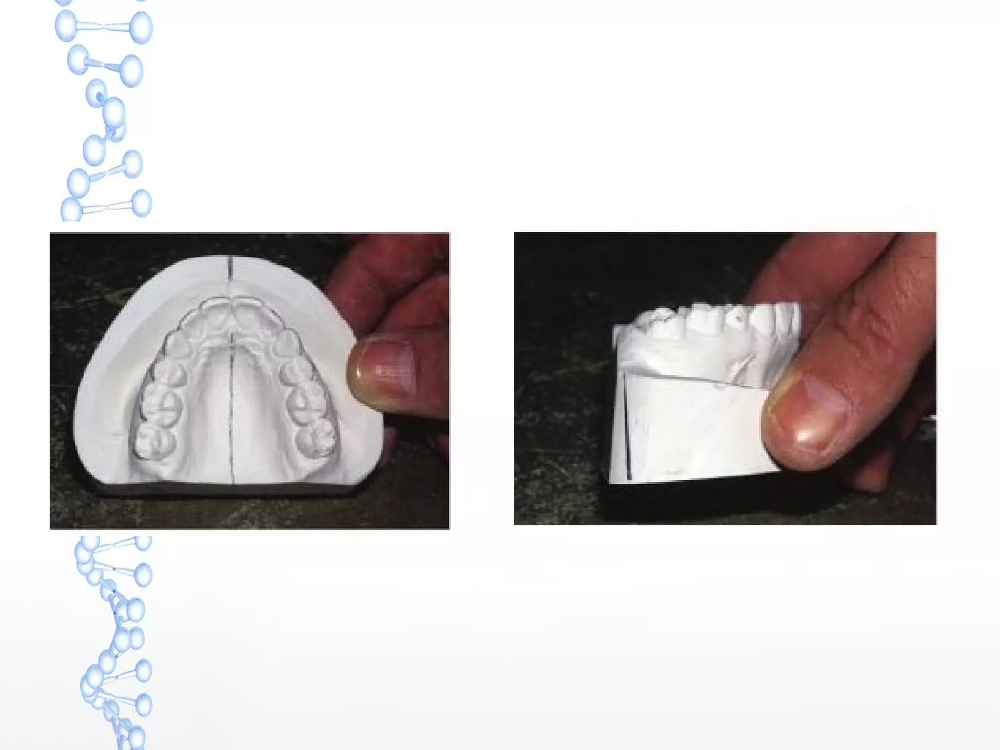 BASING AND TRIMMING OF ORTHODONTIC MODELS | ODP