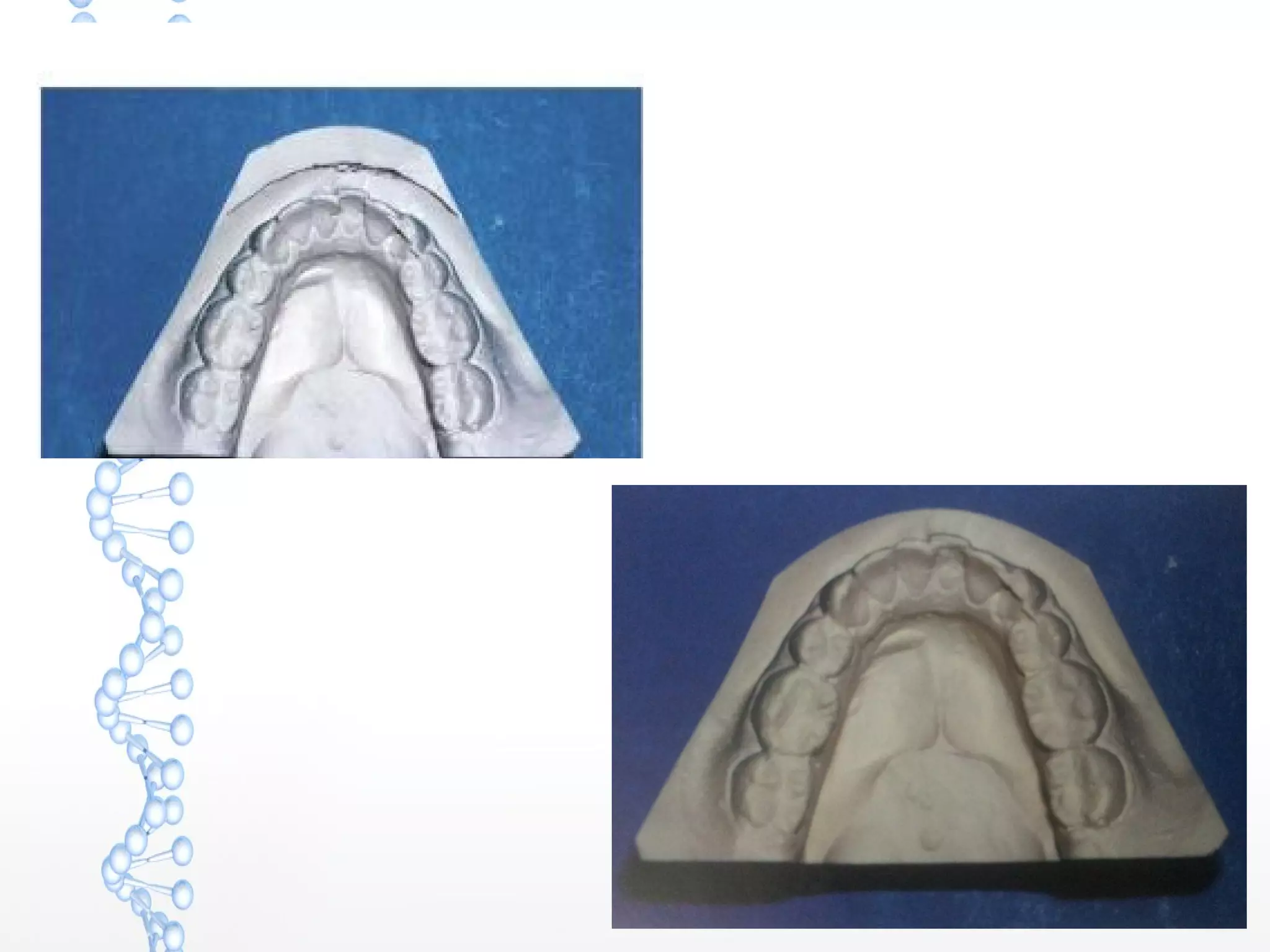 BASING AND TRIMMING OF ORTHODONTIC MODELS | ODP