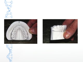 BASING AND TRIMMING OF ORTHODONTIC MODELS | ODP